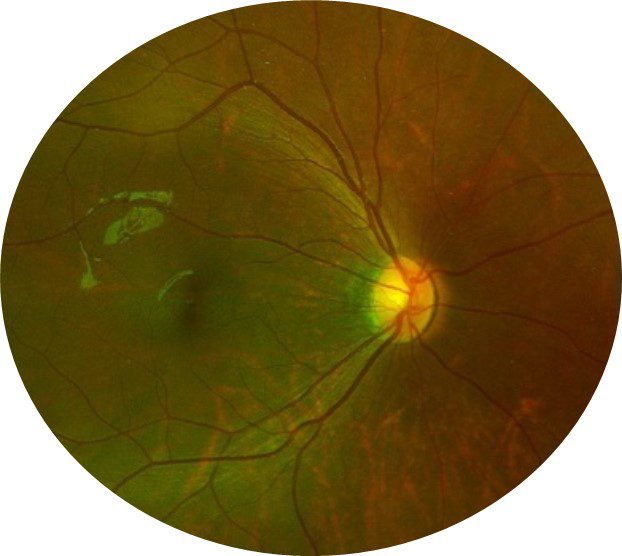 ERG Supports Diagnostic Accuracy in a Pediatric Patient - LKC Technologies