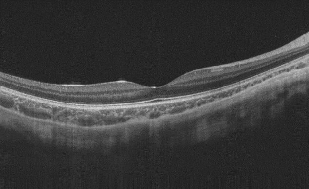 ERG Supports Diagnostic Accuracy in a Pediatric Patient - LKC Technologies