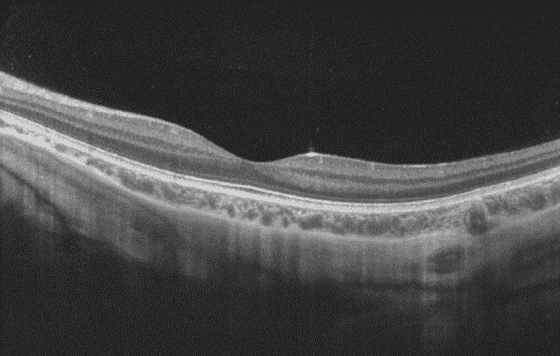 ERG Supports Diagnostic Accuracy in a Pediatric Patient - LKC Technologies